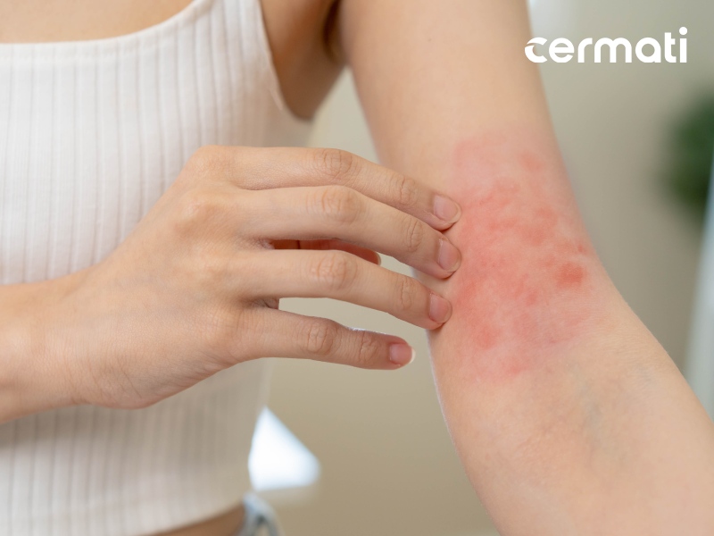 Bercak Merah di Kulit Bikin Gak Pede, Kenali Tanda dan Cara ...