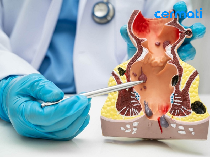 Penyakit Wasir: Penyebab, Gejala, hingga Cara Mengobatinya - Cermati.com
