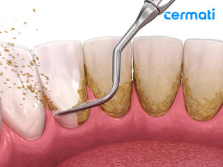 Mengenal Cara Membersihkan Karang Gigi, Mudah dan Cepat - Cermati.com
